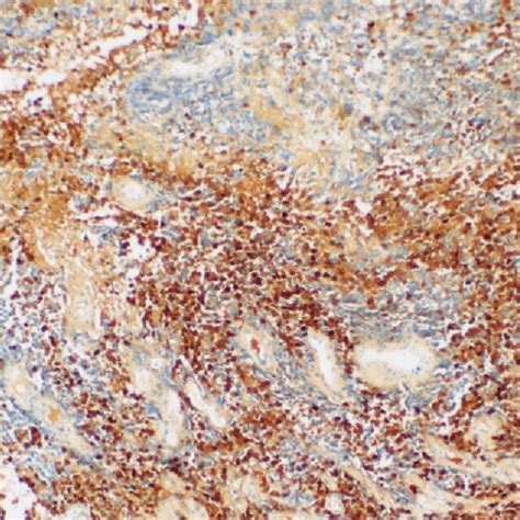 Immunoperoxidase Staining Positive For Melan A In 40× Magnification