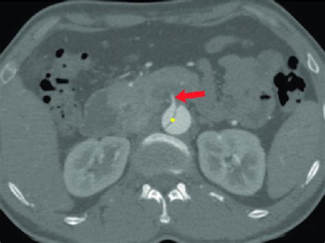 Stanford Type B Aortic Dissection Axial Ct Angiography Image Download Scientific Diagram