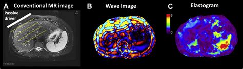 Magnetic Resonance Elastography Of Liver Magnetic Resonance Imaging