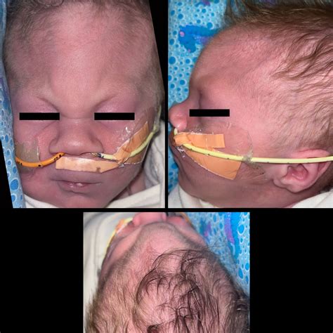 Infant With A Ridge On Their Forehead Pediatric Radiology Case