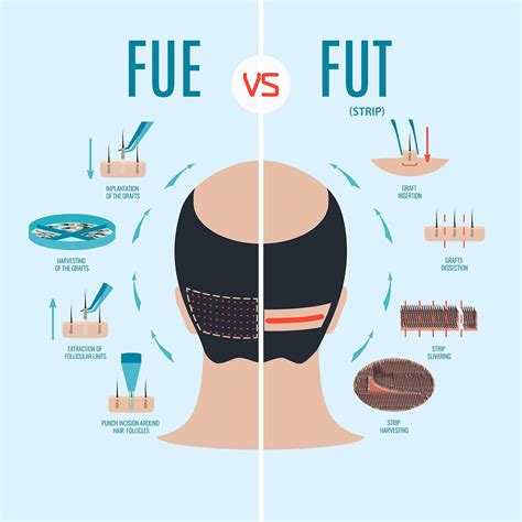Difference Between The Strip And Fue Hair Transplant Methods