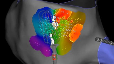 Optrell™ Mapping Catheter With Trueref™ Technology Biosense Webster