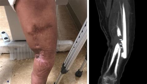 Custom 3d Printed Cage Successfully Treats Infected Tibial Shaft 3dnatives
