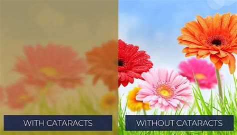 Cataract Surgery His Eyeness Ophthalmics