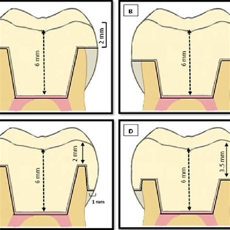 Occlusal View Of Prepared Teeth A 90 Butt Margin B Axial Reduction