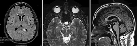 A Mri Of The Brain Showing Infarct Within The Left Splenium B Mri Of Download Scientific