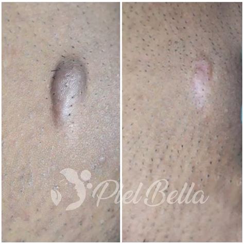 Tratamiento Para Eliminar Queloides En Lima Perú Precios