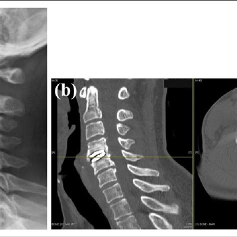 Ho Developed After Cervical Arthroplasty Plain Radiograph A And Ct