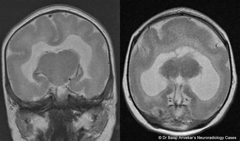 Holoprosencephaly Mri