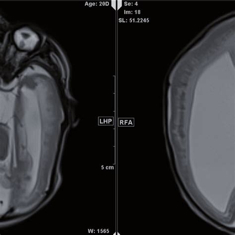 Axial T 2 Wi Image Of Brain And Orbit Showing Bilateral Microphthalmia