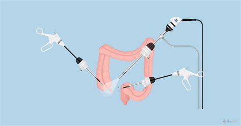 Laparoscopic Colon Surgery Types Indications Risk Factors