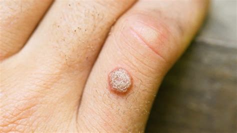 Warts Common Types And Best Treatment Methods