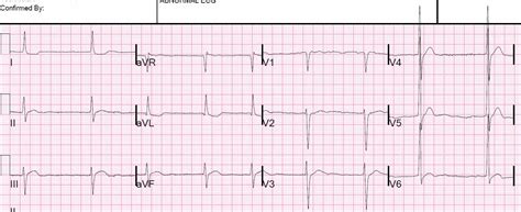 Coved St Elevation With Reciprocal St Depression What Is The Diagnosis Dr Smiths Ecg Blog