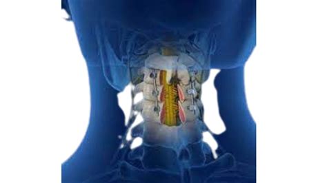 Spine Osteotomy Surgery In India Rawa Health