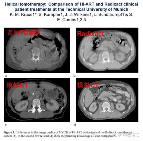 郭明教授组稿 张建英物理师：螺旋断层放射治疗简介 知乎