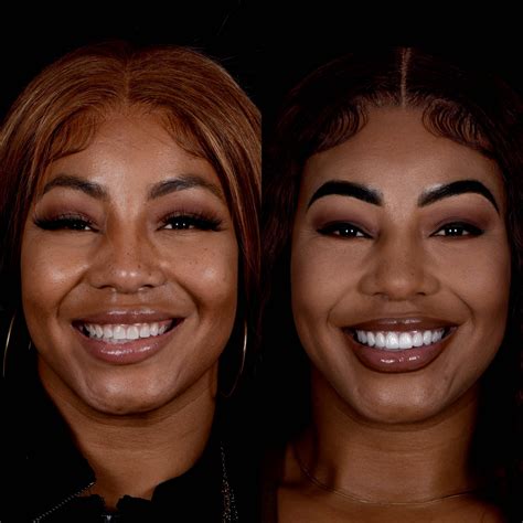 Veneers Before And After