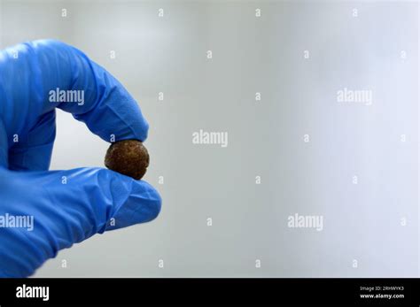 Calcoli Biliari Grandi Rimossi Chirurgicamente Dopo Colecistectomia