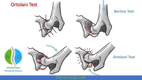 Ortolani Sign Ppt Hip Joint Orthopaedic Tests Orthopedics Dx 611