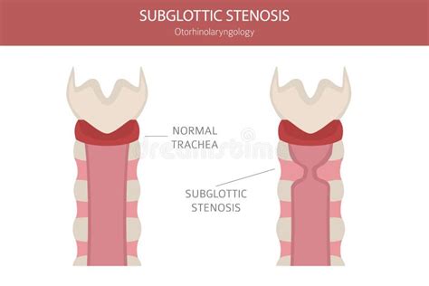 Subglottic Stenosis Diseases Pulmonology Otolaryngology Stock Vector