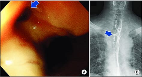 Findings Of Egd And Esophagography A On Egd The Arrow Indicates A Download Scientific