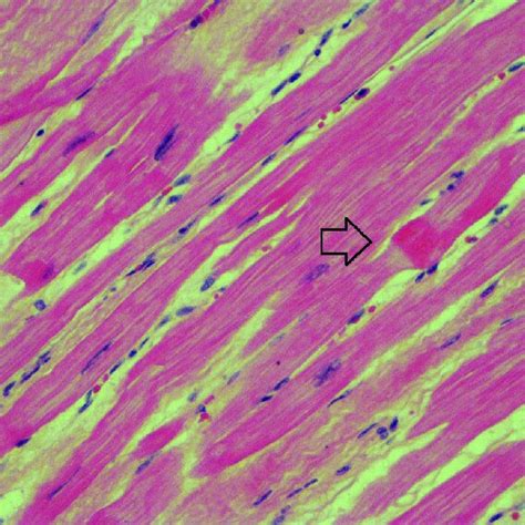 Acute Mi Pathology Appearance Consistent With 1 3 Days Hande ×100 Download Scientific
