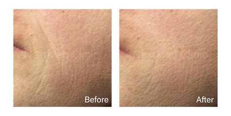 Best Plinest Treatment In Malaysia Nextmed Clinic