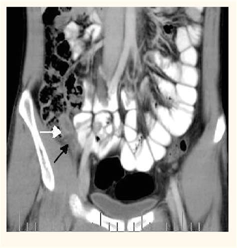 Figure 1 From Stump Appendicitis Following Laparoscopic Appendectomy