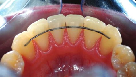 Retainers Nightguard Myobrace Clement Dental