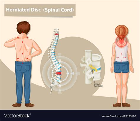 Diagram Showing Herniated Disc In Human Royalty Free Vector