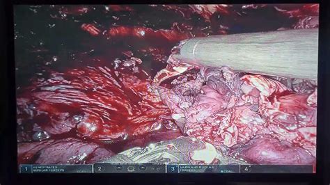 Robotic Lung Surgery Decortication Youtube