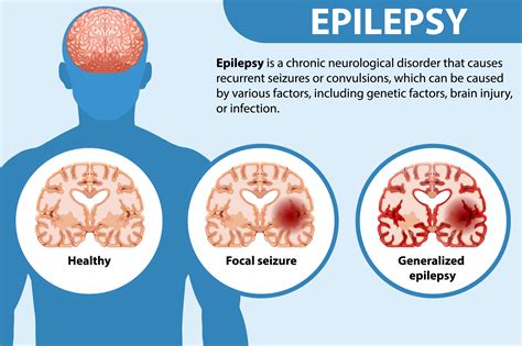 Understanding Epilepsy With Best Epilepsy Doctor In Faridabad