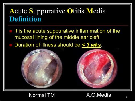 Acute Otitis Media Aom Secretory Otitis Media Ome