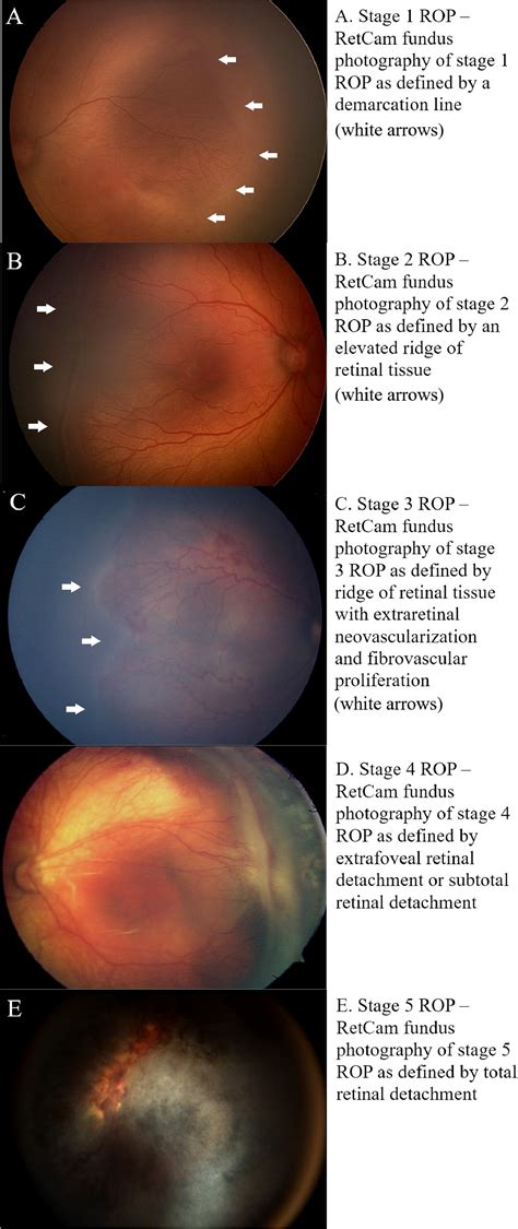 Retinopathy Of Prematurity Stage 3