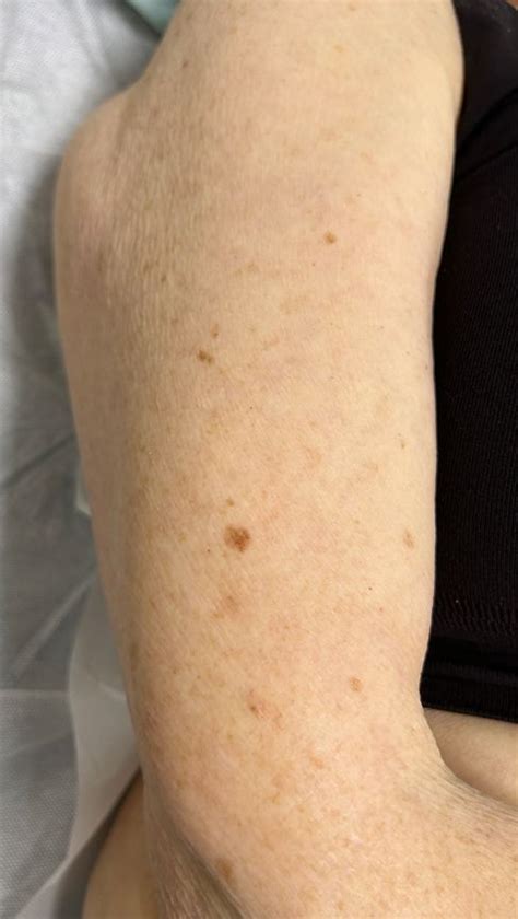 Skin Cancer Moles On Arms