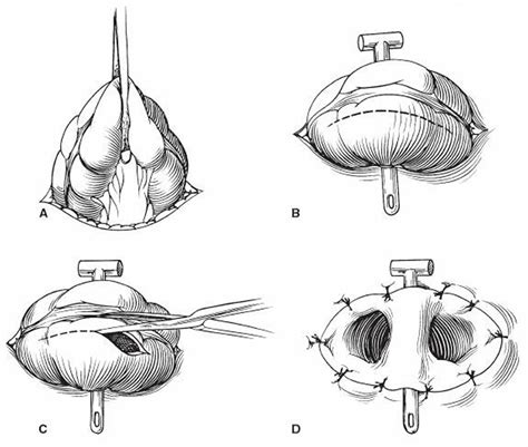 Is A Colostomy Considered A Disability At Andrew Leichhardt Blog