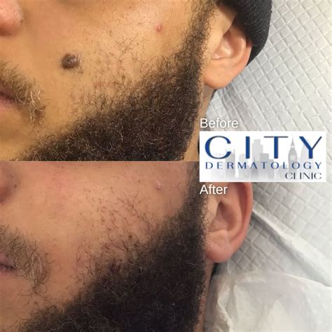 Shave Excision Mole Removal How It Works And What To Expect