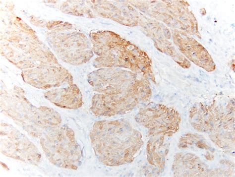 49 Year Old Female With Granular Cell Tumor Of The Abdominal Wall The