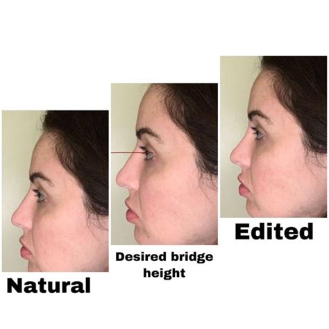 Wide Nose Bridge