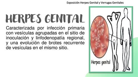 Herpes Genital Y Verrugas Genitales Gagabell Udocz