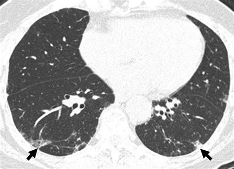 Imaging Of Pulmonary Fibrosis An Update From The Ajr Special Series