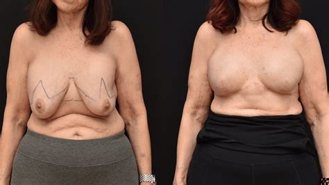 Mastectomy Breast Reconstruction Brian P Dickinson Md