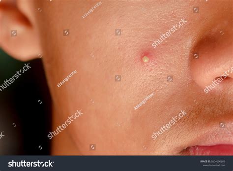 Purulent Pustules 152 Images Photos Et Images Vectorielles De Stock