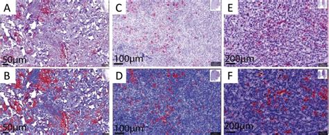 A C And E Show The Original Cd30 Ihc Stained Scan Section B D And