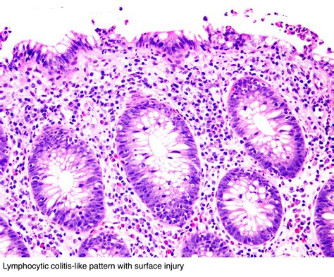 Pathology Outlines Anti Pd1 Associated Colitis
