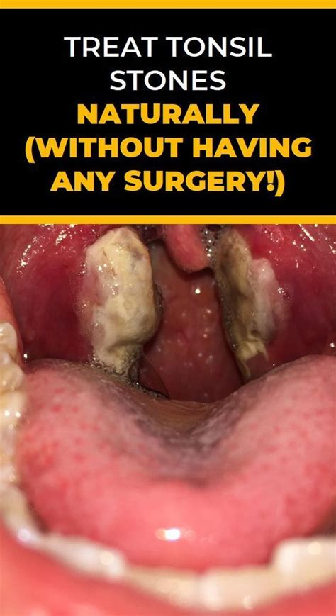 Top 8 Home Remedies To Remove Tonsil Stones Artofit