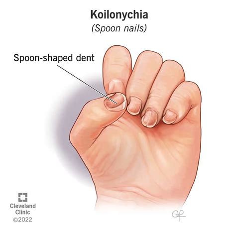 Koilonychia Spoon Nails What It Is Causes And Treatment Spoon Shape
