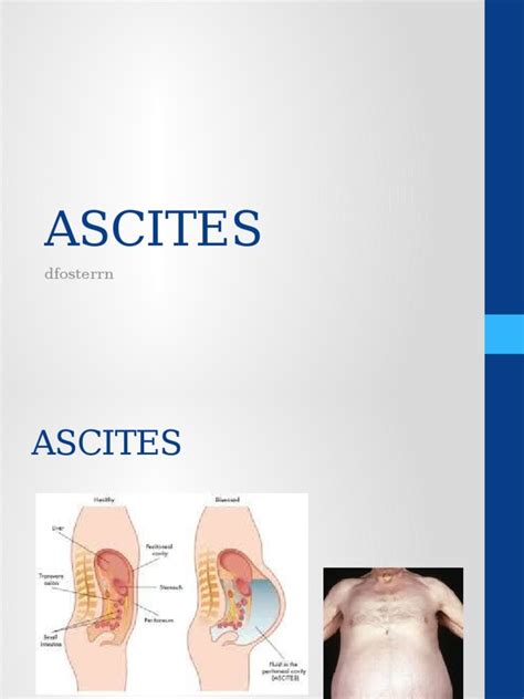 Ascites Presentation Pdf Cirrhosis Hepatitis