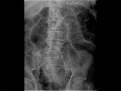 Abdomen And Retroperitoneum 16 Gastrointestinal Tract Case 167 Duodenum And Small Bowel