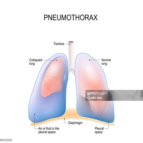 Pneumothorax Collapsed Lung High Res Vector Graphic Getty Images