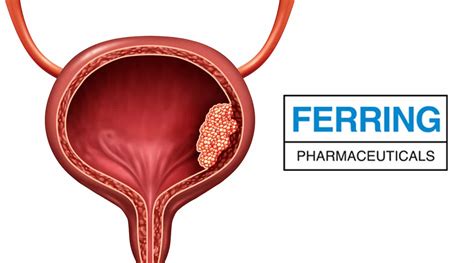 Fda Approves Gene Therapy For Bladder Cancer Adstiladrin Anton Health